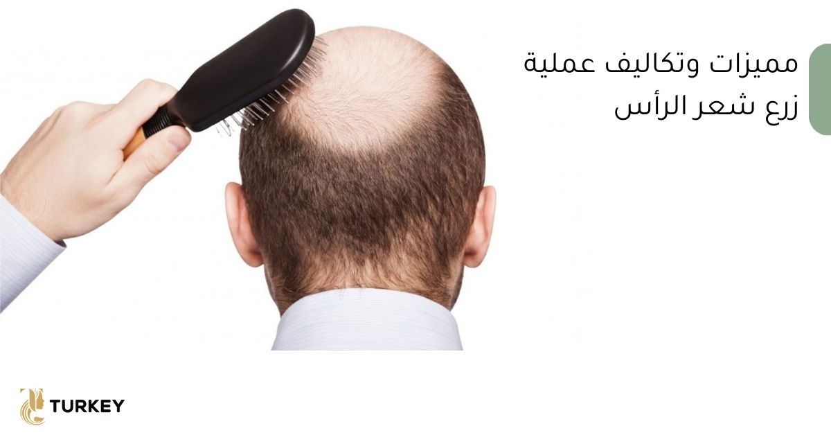 عملية زرع شعر الرأس | مميزاتها وتكاليفها - مركز تركي هير مصر