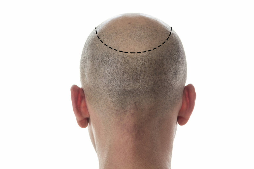 شكل الرأس بعد زراعة الشعر وأهم 6 ممنوعات - مركز تركي هير مصر